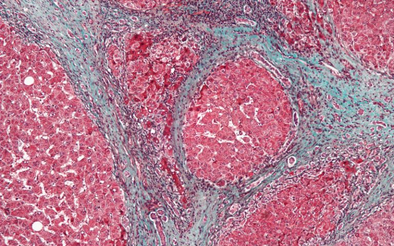 Urea Alta en Sangre: Causas, Síntomas, y Tratamientos - cuídateCV