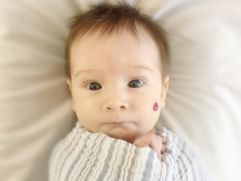 Qué es un angioma y cómo se cura - CuídateCV